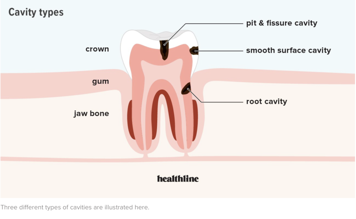 How to Treat and Prevent Dental Root Cavities – Tooth Truth For You How to Treat and Prevent Dental Root Cavities – Tooth Truth For You